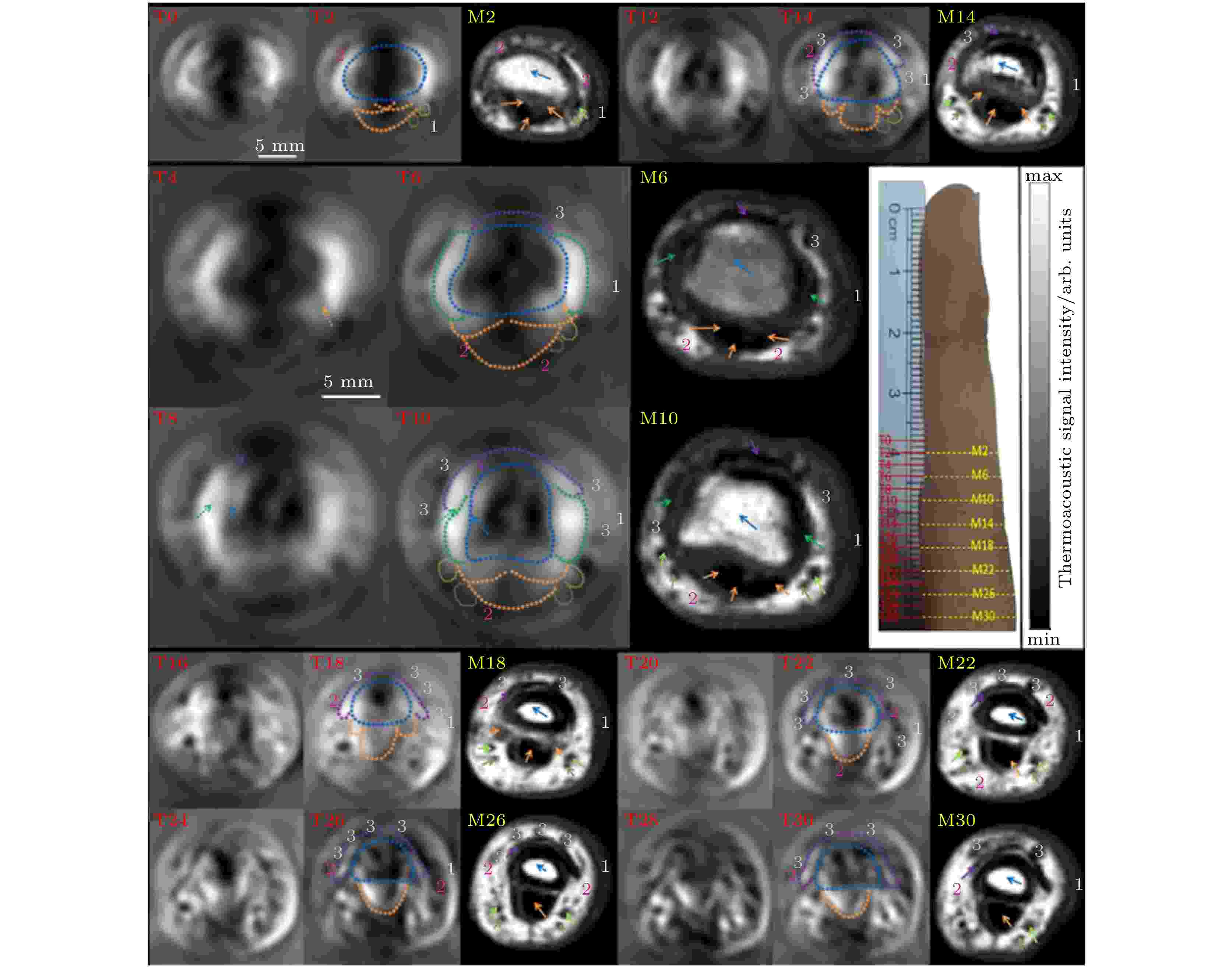 Biomedical microwave-induced thermoacoustic imaging Biomedical microwave-induced thermoacoustic imaging